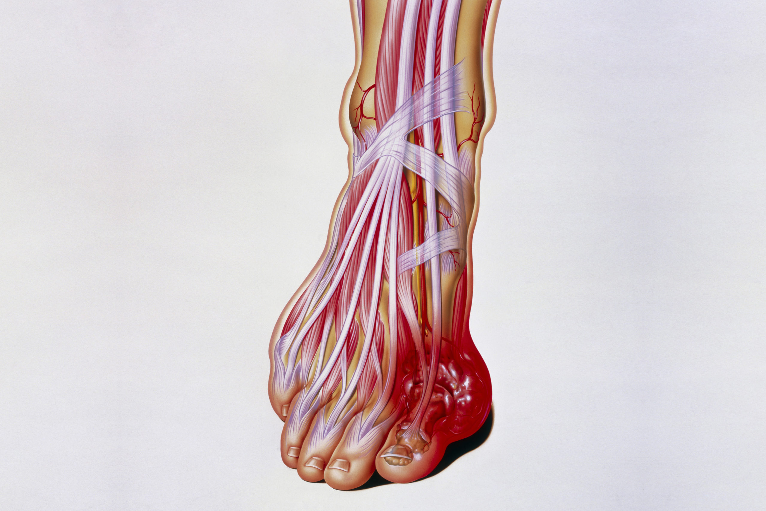 Lifestyle Habits that are Putting Millennials at Risk of Gout - Purmedica